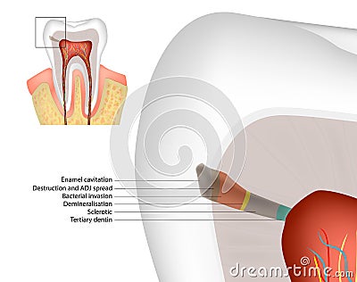 Histopathology Of Caries In Enamel And Dentine. Enamel Dentin Pulp ...