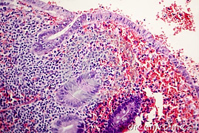 Histopathology Of Chronic Appendicitis Royalty-Free Stock Photo ...