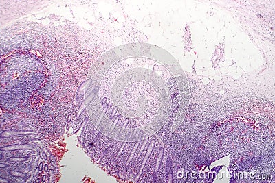 Histopathology Of Chronic Appendicitis Stock Photography ...