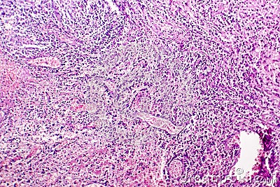 Histopathology Of Chronic Cholecystitis Royalty-Free Stock Photography ...