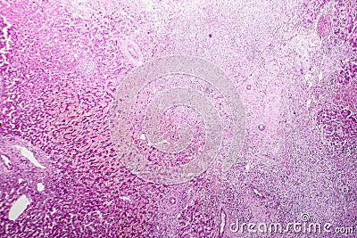 Histopathology Of Liver Abscess Royalty-Free Stock Image ...