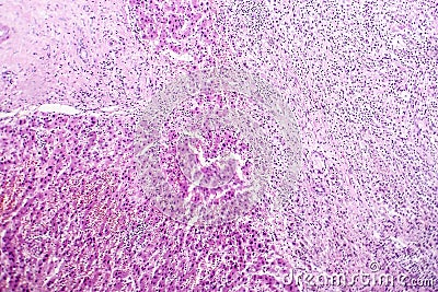 Histopathology Of Liver Abscess Royalty-Free Stock Photo ...