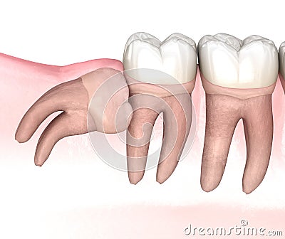 Horizontal Impaction Of Wisdom Tooth. Medically Accurate Tooth 3D ...