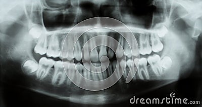 Horizontal X-ray Dental Tracking of Human Teeth, Human Face Bones ...