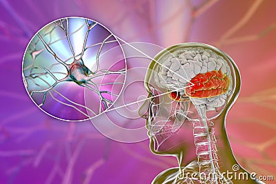 Human Brain With Highlighted Temporal Lobe And Close-up View Of Neurons ...
