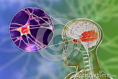 Human Brain With Highlighted Temporal Lobe And Close-up View Of Neurons ...