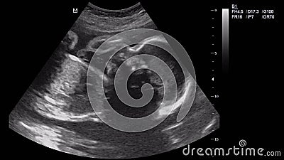 Human Embryo on an Ultrasound Display Stock Video - Video of ...