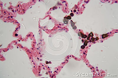 Human Lung Tissue With Dust And Coal Particles Under The Microscope ...