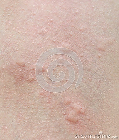 Human Skin, Presenting An Allergic Reaction Stock Photo - Image: 39195174