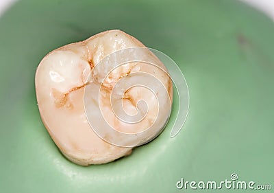 Human Tooth - Caries Stock Photography | CartoonDealer.com #13984208