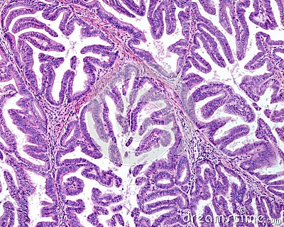 Human Uterus. Endometroid Carcinoma Royalty-Free Stock Photography ...