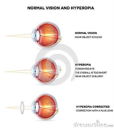 Hyperopia And Normal Vision Stock Photo - Image: 38614740