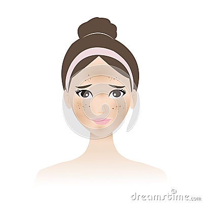 Hyperpigmentation And Melasma Is On The Woman Face Vector Illustration ...