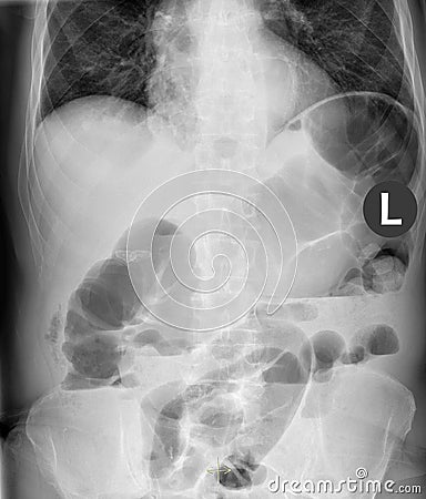 Ileus Stock Photo - Image: 68539424
