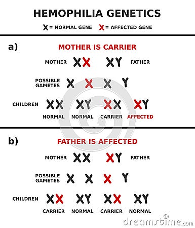 Hemophilia Genetics Infographic. Hemophilia Is An X-linked Recessive ...