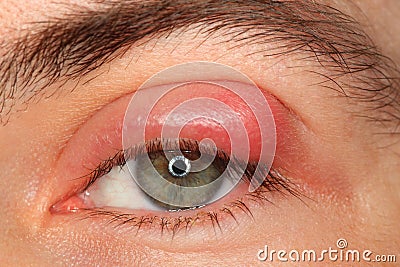 Illness Person Eye With Sty And Pus Stock Photography - Image: 15587062