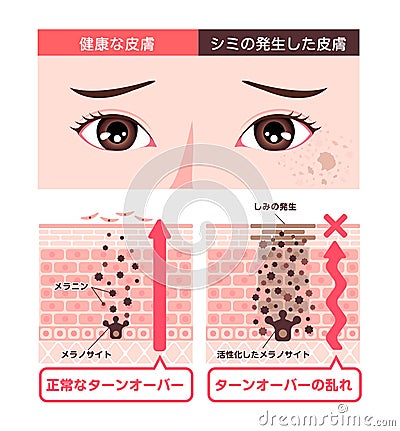 Illustration Of How Skin Spots (hyperpigmentation) Are Created Cartoon ...