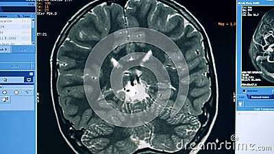 Image of a Human Brain in the MRI Interface Stock Footage - Video of ...