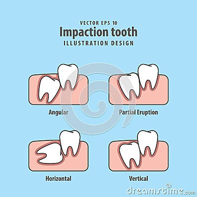Impaction Tooth Illustration Vector On Blue Background. Dental ...