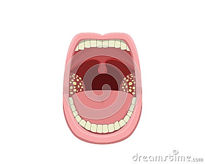 Inflamed Tonsillitis In Vector Design | CartoonDealer.com #99247648