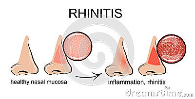 Inflammation Of The Nasal Mucosa Stock Vector - Image: 64714553