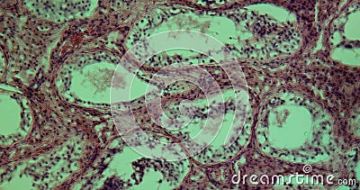 Inguinal Testicles Diseased Stock Footage - Video of research, inguinal ...