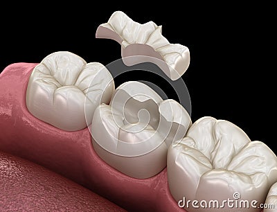 Inlay Ceramic Crown Fixation Over Tooth. Medically Accurate 3D ...