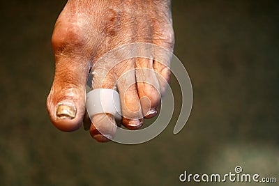 Interdigital Pads. Partitions. Foot. Corn On Toes. Curvature Of Fingers ...