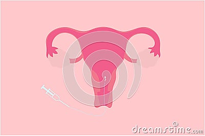 IUI Intrauterine Insemination Vector Illustration | CartoonDealer.com ...