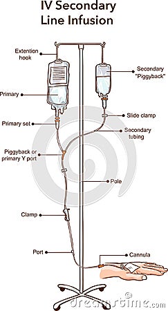 IV Secondary Line Infusion Vector Illustration | CartoonDealer.com ...