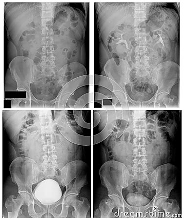 IVP Pyelogram Of Patient With Kidney Stone Royalty Free Stock Images ...