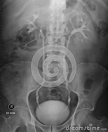 IVU Xray For Kidney Stones Stock Images - Image: 4862334