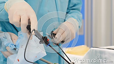 Laparoscopic Cholecystectomy Instrument. Real Surgery, Abdominal ...
