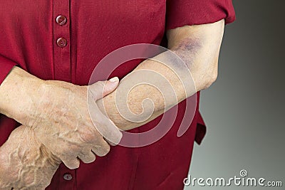 Large Hematoma On Human Arm Stock Photo - Image: 52499506