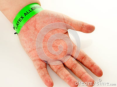Latex Allergy Rash Stock Image - Image: 36243311