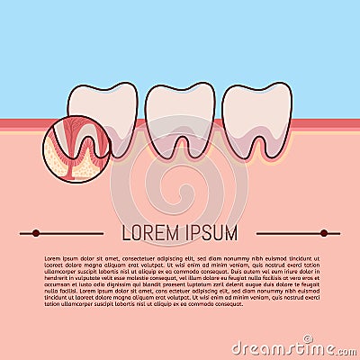 Layout Cross-section Structure Inside Tooth Illustration Vector On Blue ...