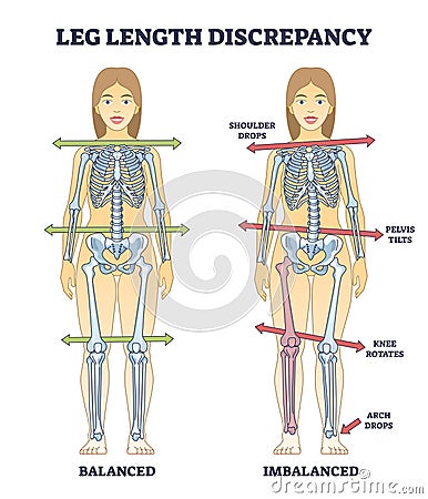 Leg Length Discrepancy Condition With Imbalanced Skeleton Outline ...