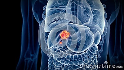 Leverkanker stock footage. Video of animatie, biologie - 69608702