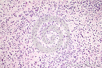 Malignant Cells, Photo Under Microscope Royalty-Free Stock Image ...