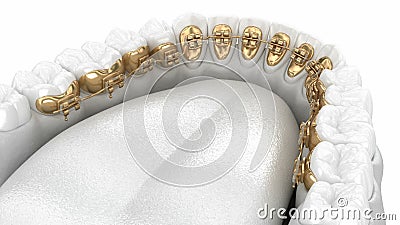 Lingual Braces System. 3D Animation Concept of Golden Braces Stock ...