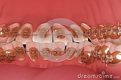 Lingual Braces System. 3D Illustration Concept Of Golden Braces Royalty ...