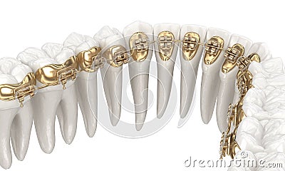 Lingual Braces System. 3D Illustration Concept Of Golden Braces ...