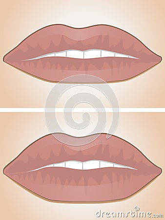 Lip Filler Before And After Cartoon Vector | CartoonDealer.com #20899995