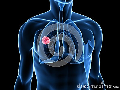 Longkanker Stock Foto - Afbeelding: 11898440