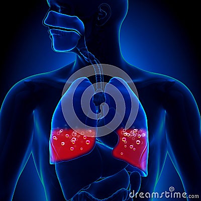 Longoedeem - Bloed In Longen Stock Illustratie - Afbeelding: 41619150