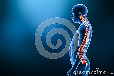 Lordosis Pathology With Man Model From Lateral View 3D Rendering ...