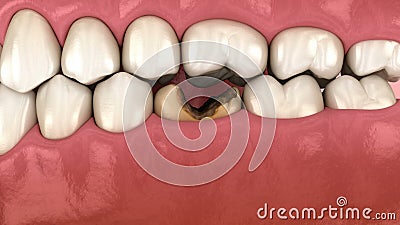 Losing Molar Tooth. 3D Animation of Human Teeth and Dentures Stock ...