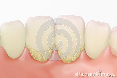 Lower Front Teeth With Heavy Tartar Buildup Royalty-Free Stock ...