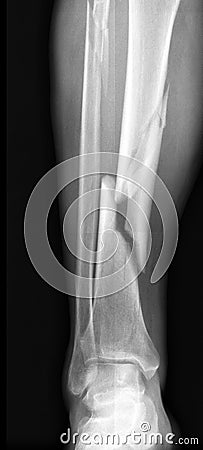 Lower Leg Fracture Royalty Free Stock Photos - Image: 19294748
