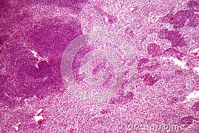 Lymph Node Cells Under The Microscope. Royalty-Free Stock Image ...